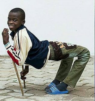 12-Year-Old Boy Full Of Joy After Undergoing Successful Surgery To ...