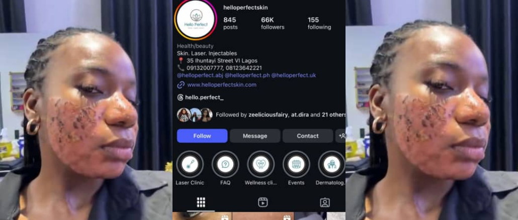 Clinic Threatens Lady With Jail After Acne Treatment Leaves Permanent ...